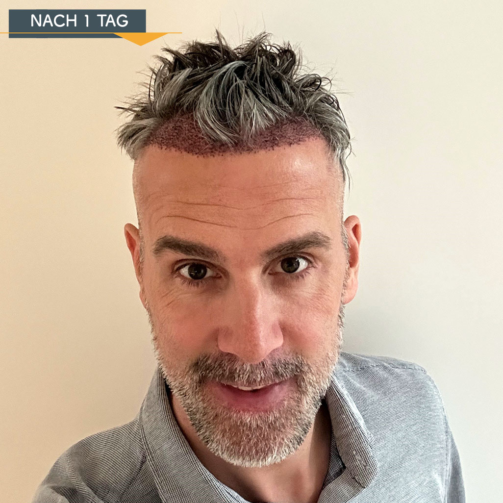 Haartransplantation von Stefan Maierhofer | Moser Medical